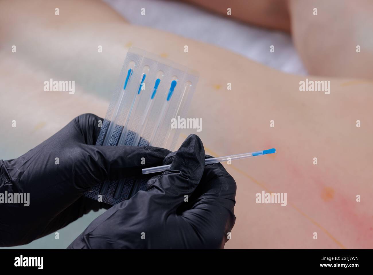 physician therapist holding thin needles close-up before myofascial ...