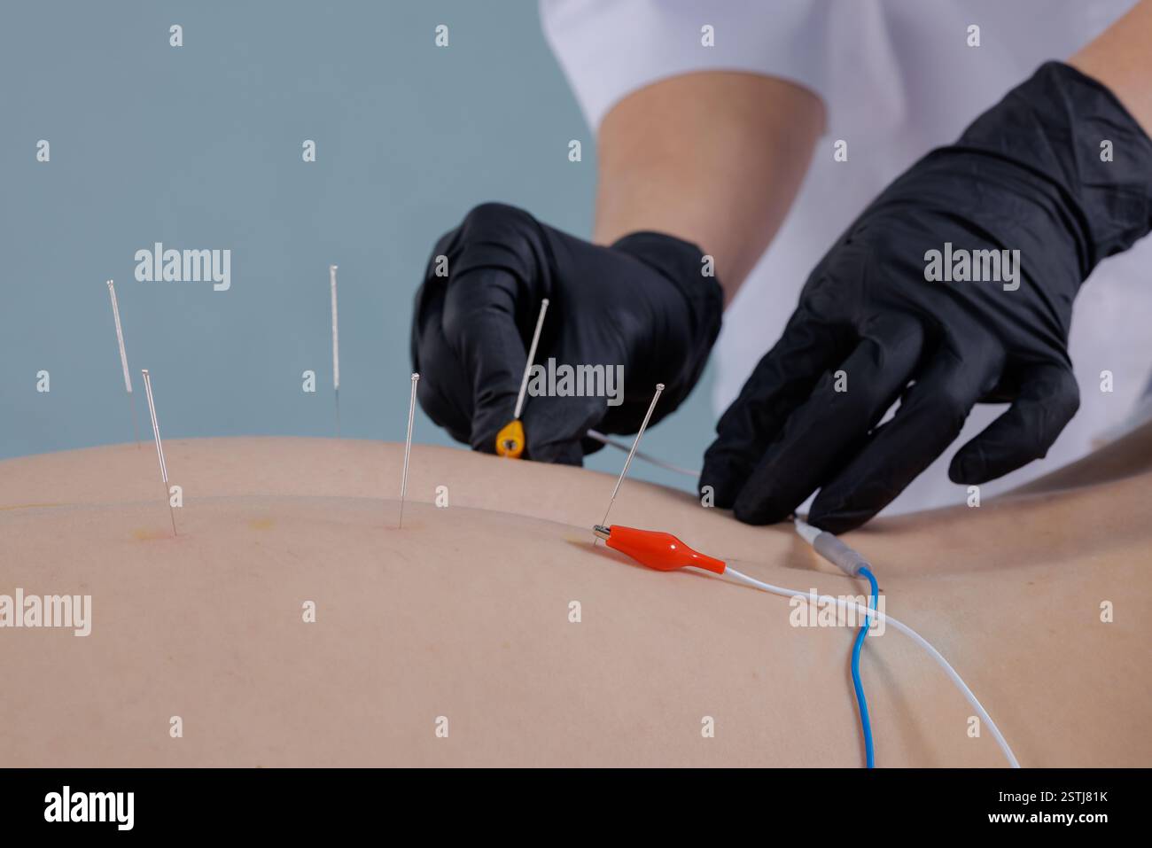 A physician connects an Electromyostimulator to needles on a man's back ...