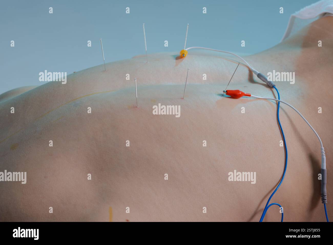 A physician connects an Electromyostimulator to needles on a man's back ...