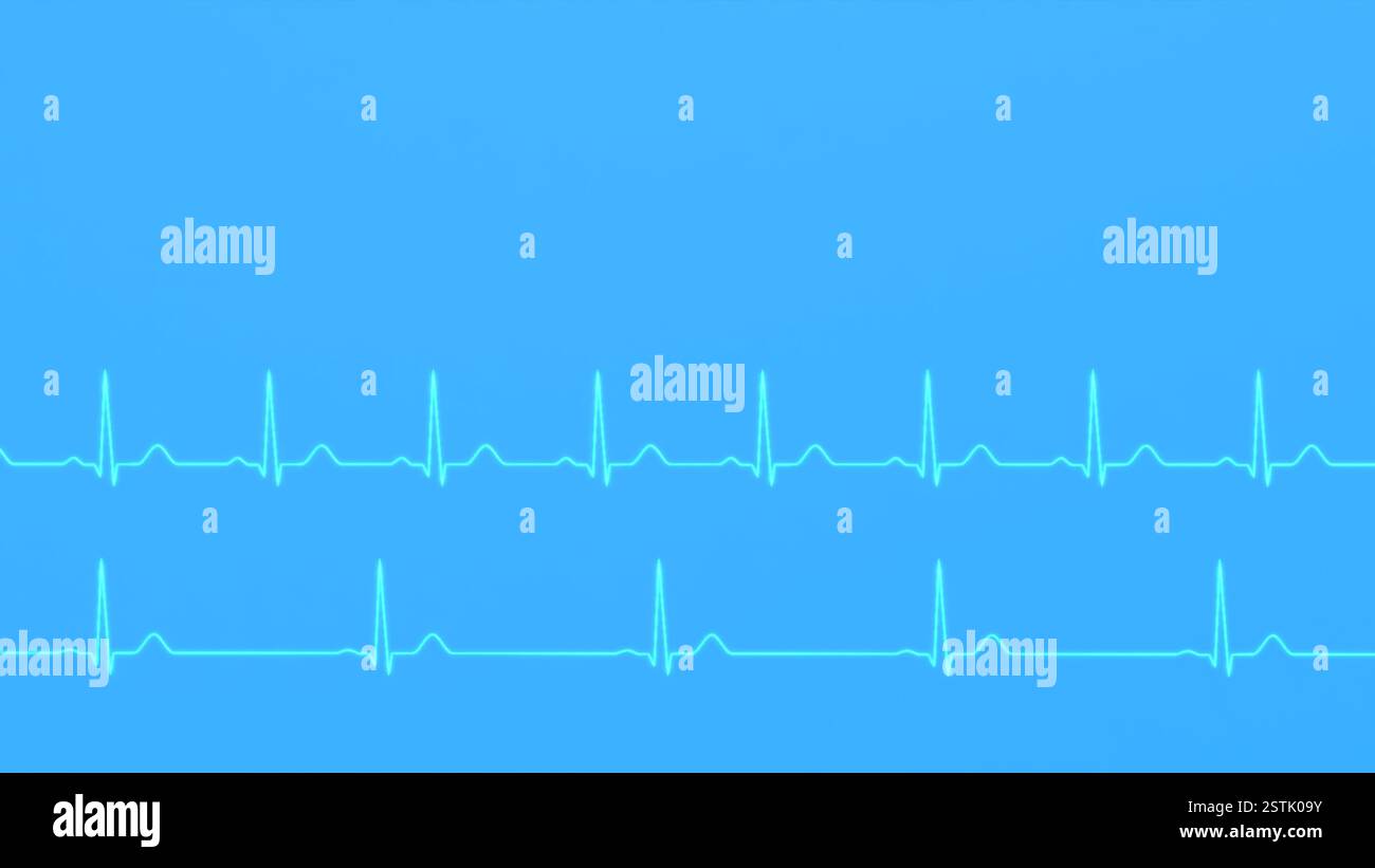 Comparison of ECG of normal heart rhythm and bradycardia Stock Photo ...