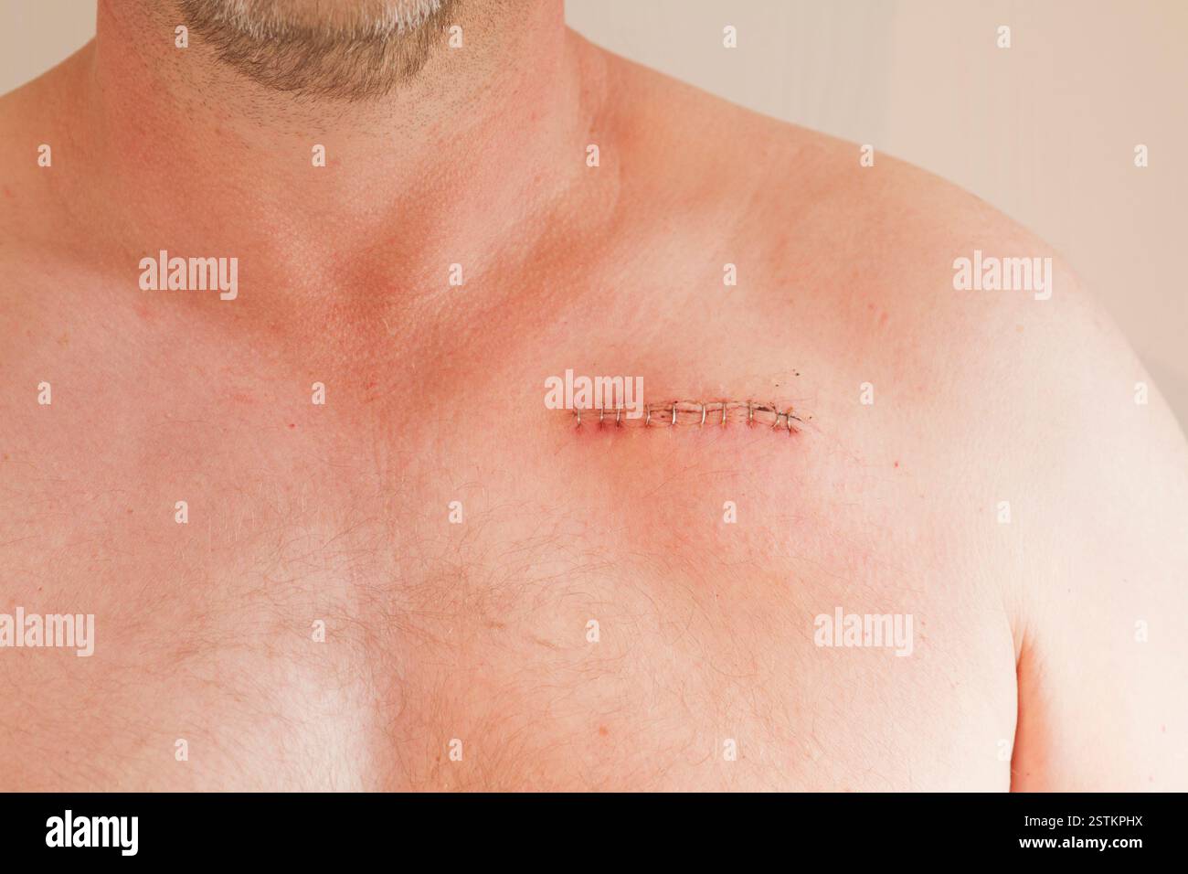 Pacemaker chest scar hi-res stock photography and images - Alamy