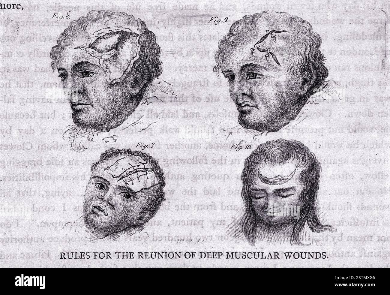 Four diagrams illustrating heads with severe wounds, demonstrating how ...