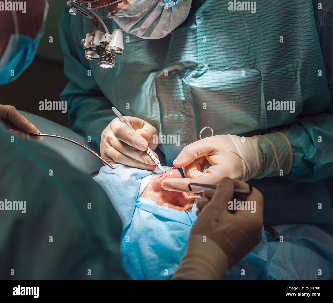 Cosmetic surgery on nose. The surgeon cuts the flesh Stock Photo - Alamy