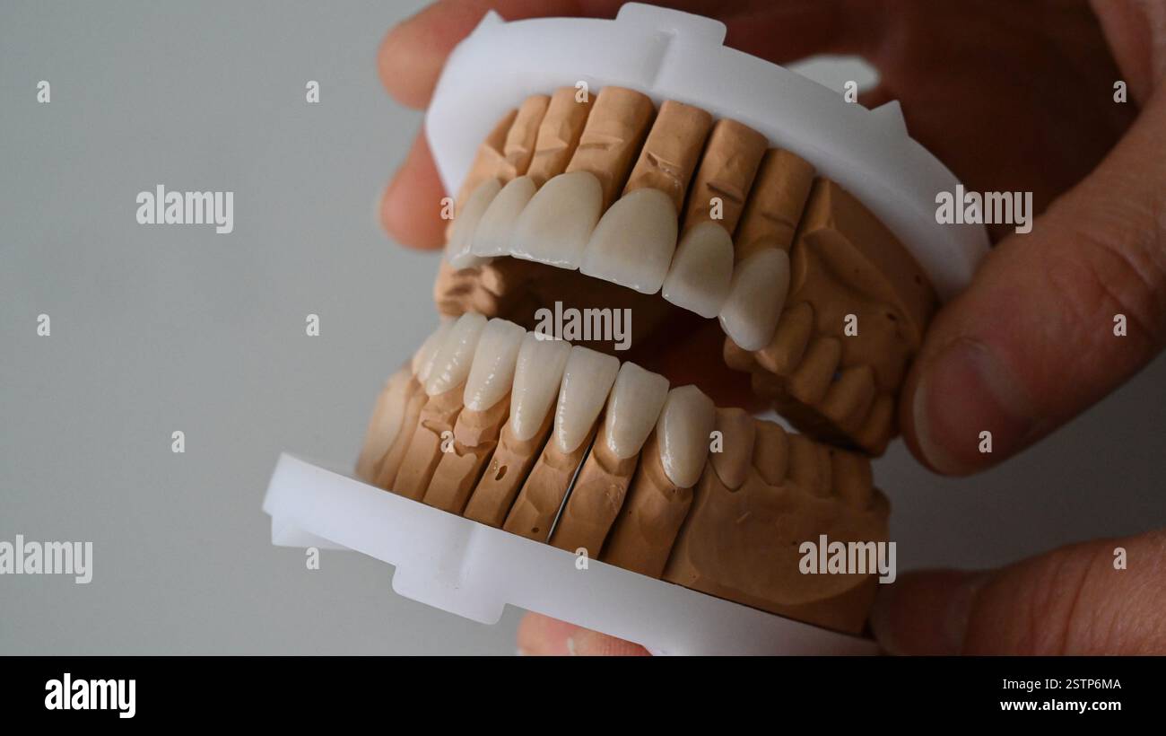Zircon teeth veneers from the dental technician in the lower jaw Stock ...