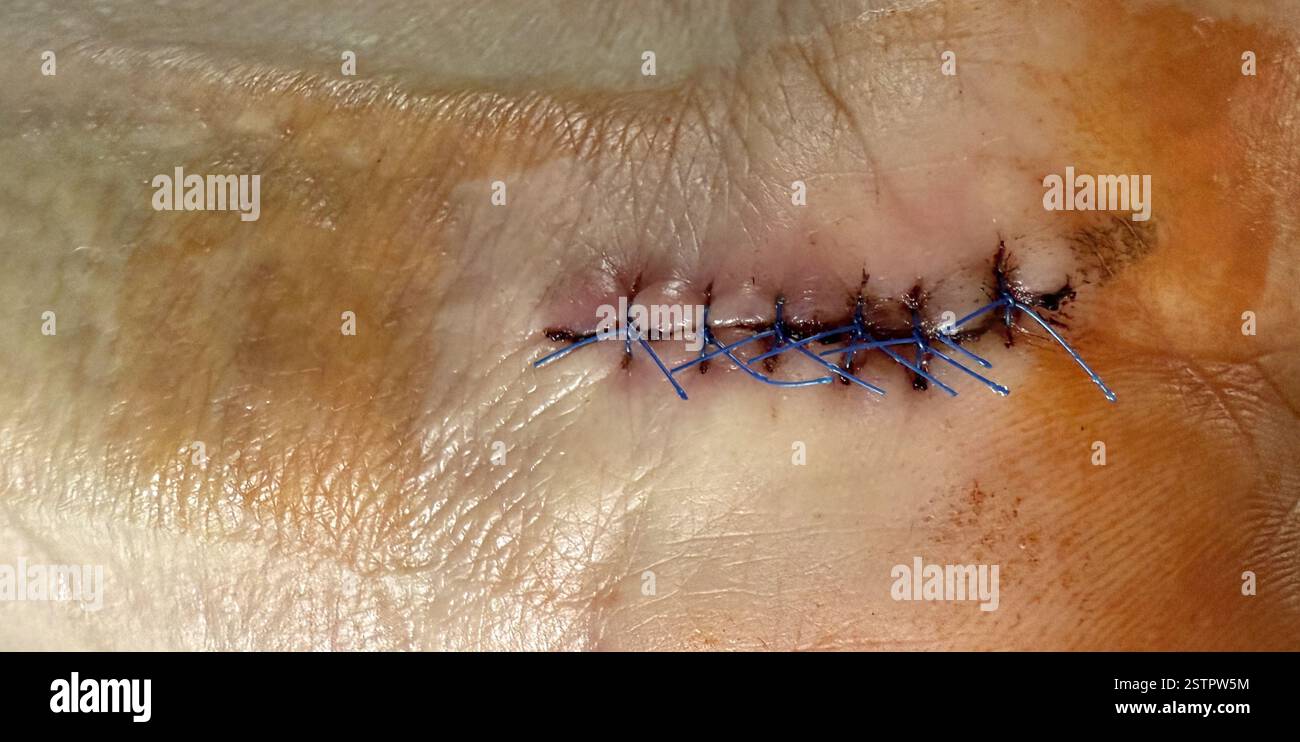 Wound suture body surgery operation bandage Stock Photo - Alamy