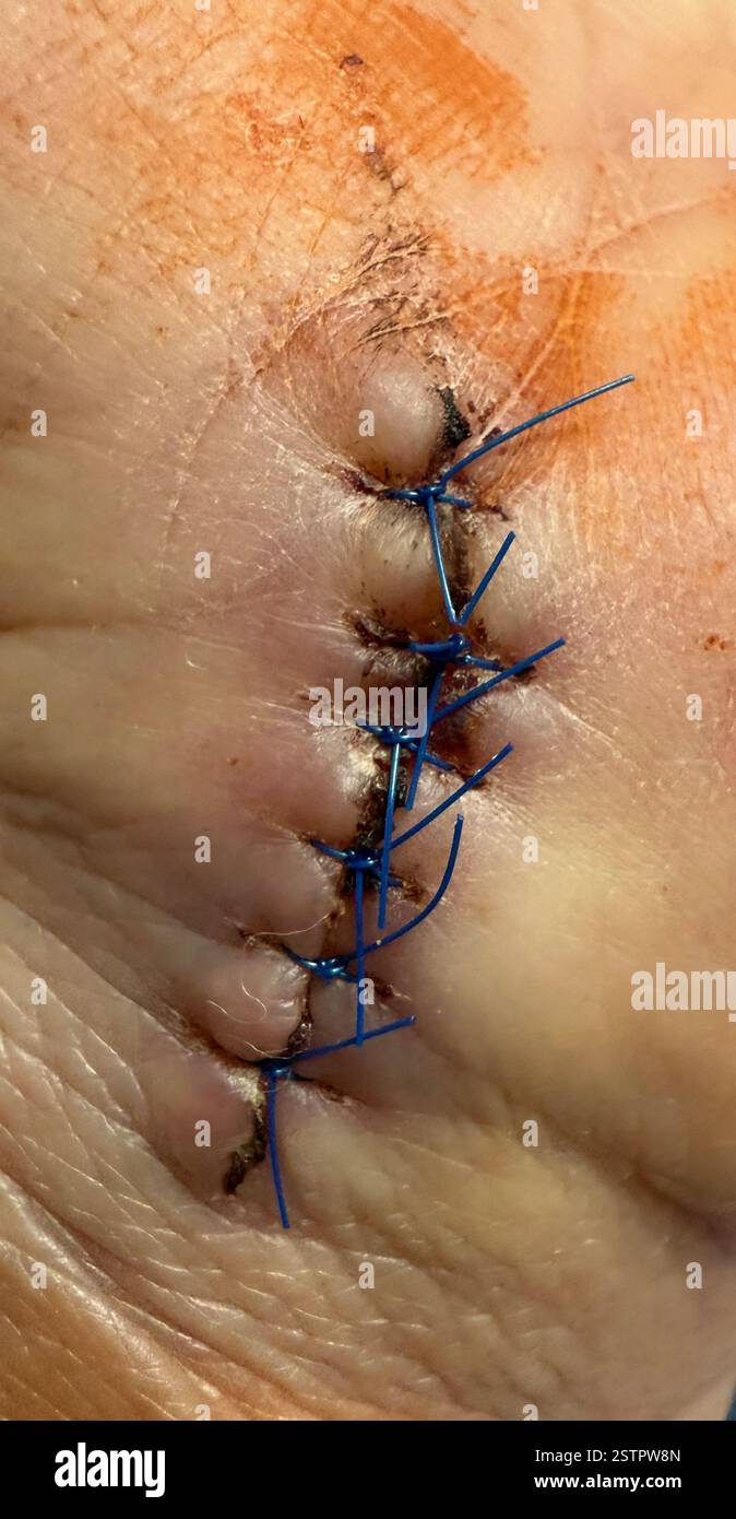 Wound suture body surgery operation bandage Stock Photo - Alamy