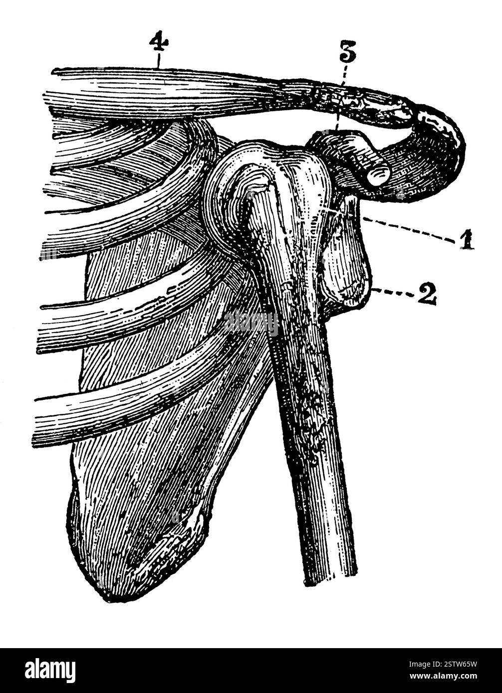 Dislocation of the shoulder. Illustration of the 19th century. Germany ...