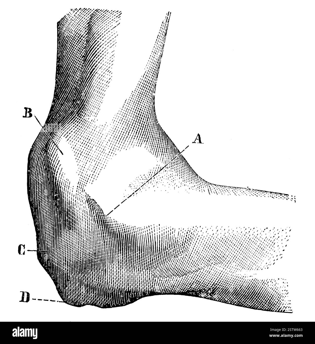 Appearance of the dislocated elbow joint. Illustration of the 19th ...