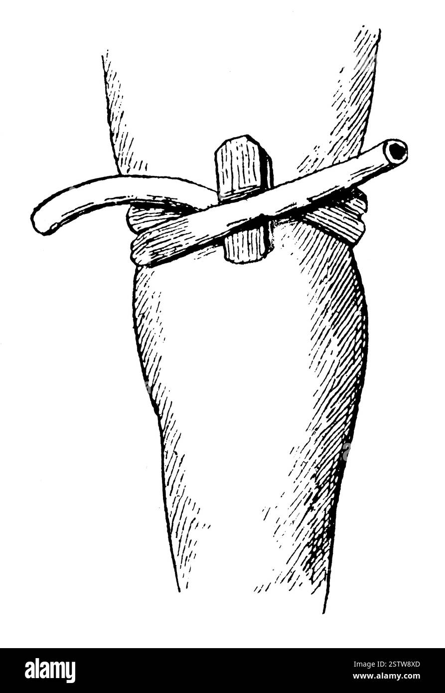 Elastic constriction of the thigh. Illustration of the 19th century ...