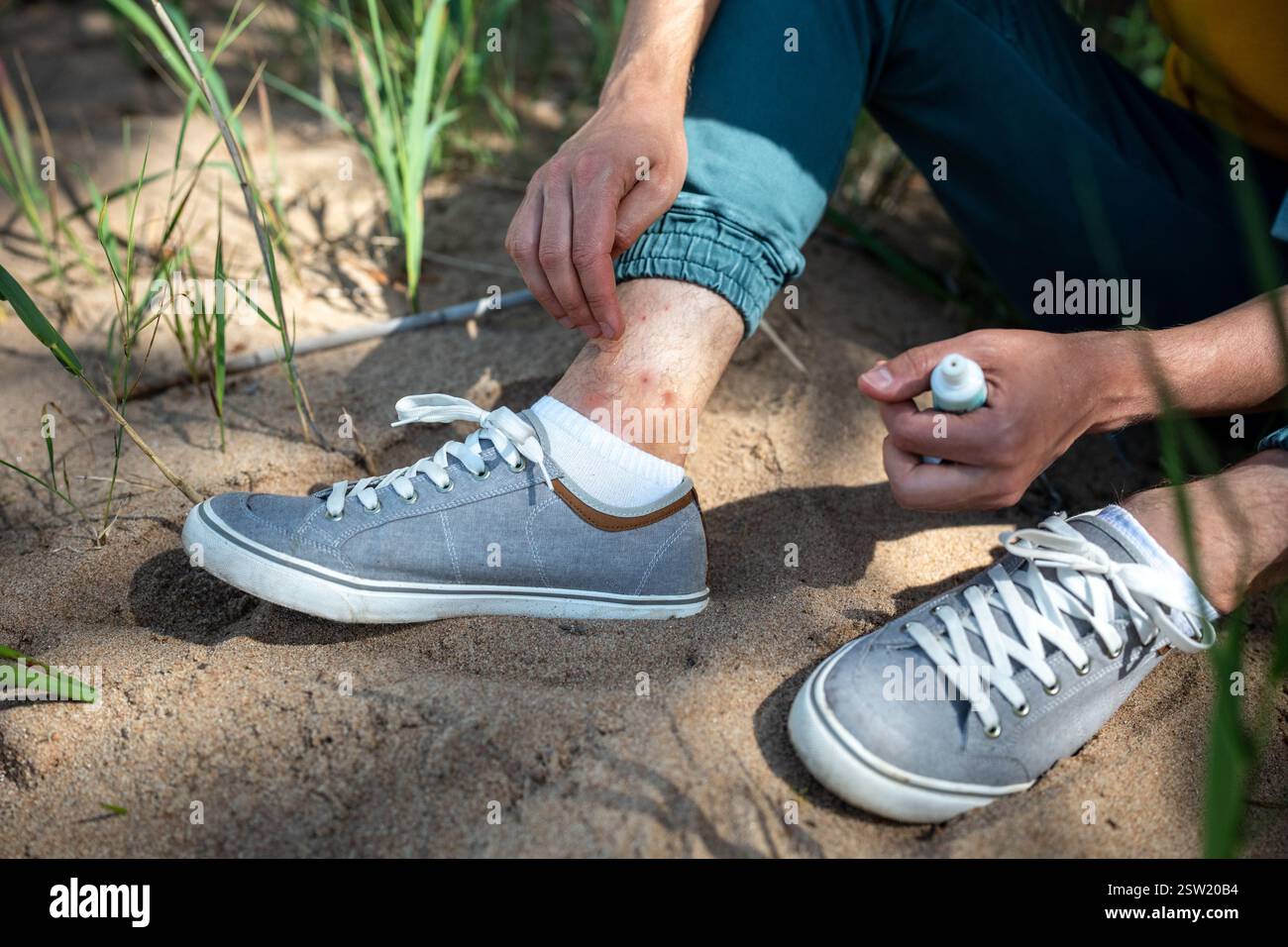 First aid for mosquito bites. Cropped man treat insect bites on ankles ...