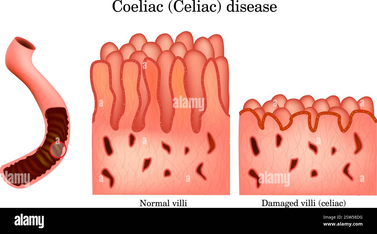 Coeliac Disease Intestinal Damage Illustration. Celiac Disease ...