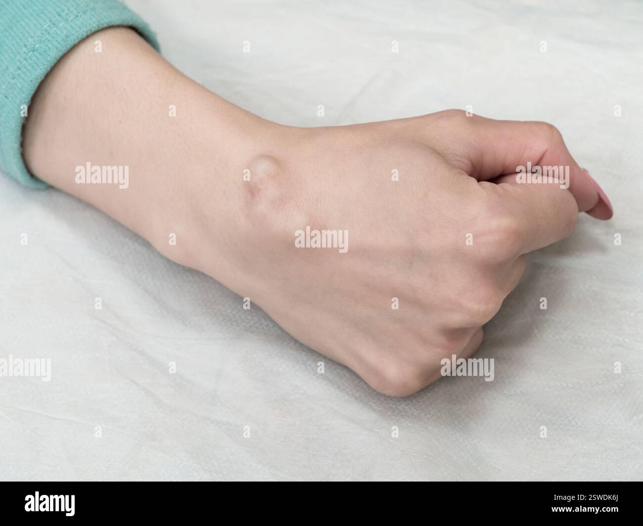 Big cyst hygroma, fluid filled lump associated with a joint, a tumor or ...