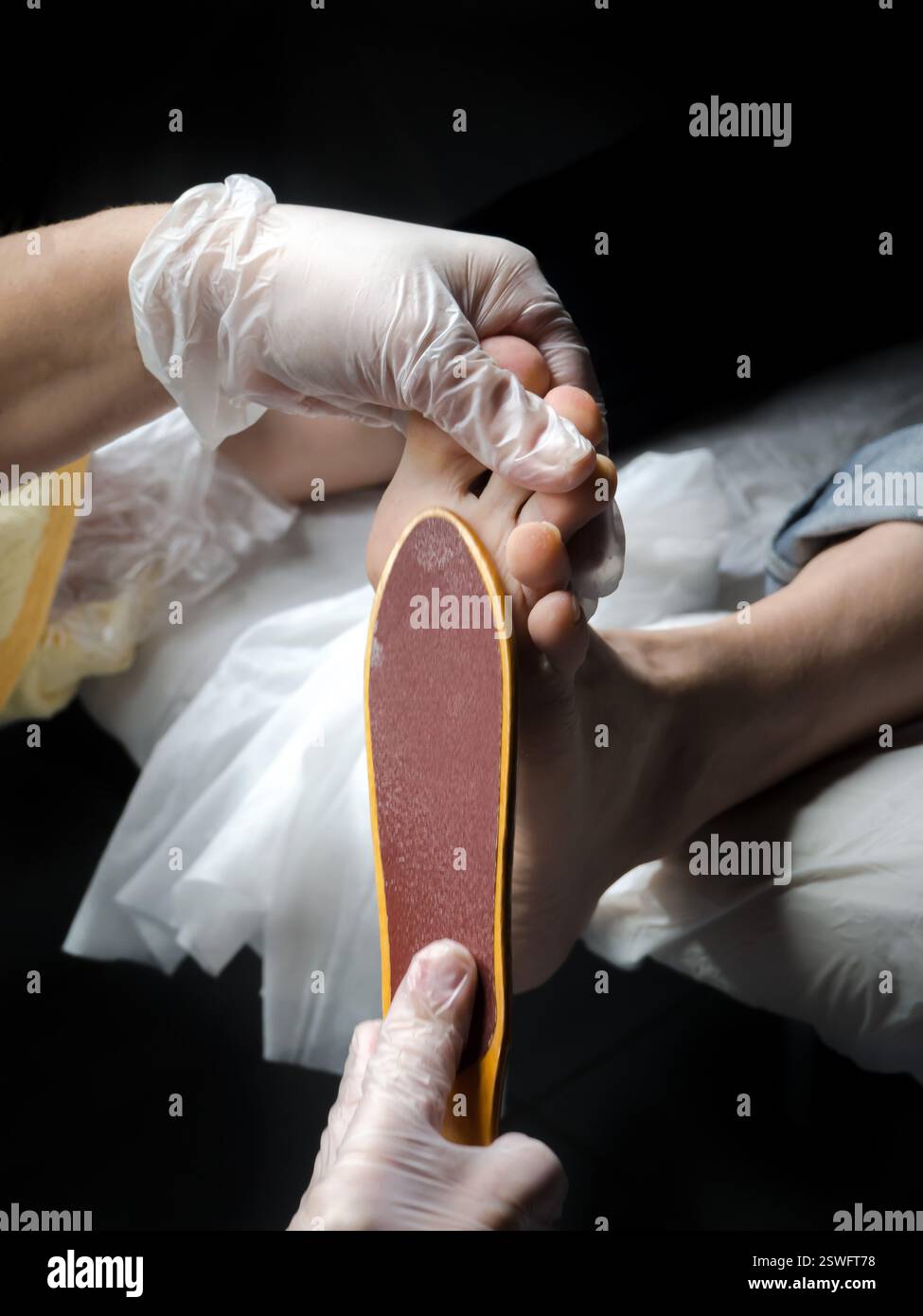 Close up of Calluses. Painful corn on foot. Treatment of corns on the ...