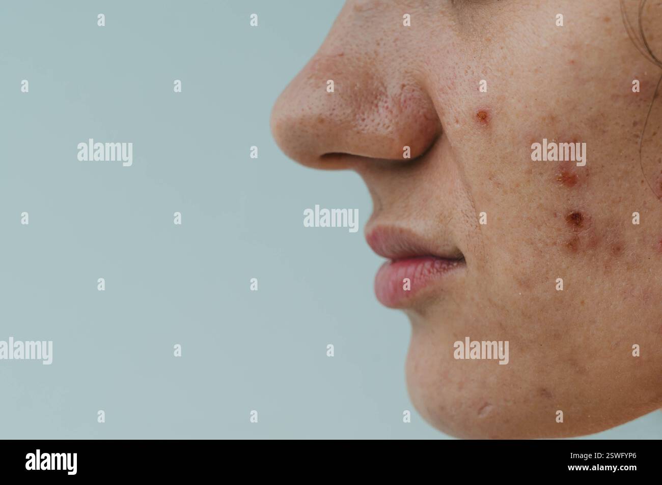 A large portrait of a young woman with skin problems - pimples, acne ...