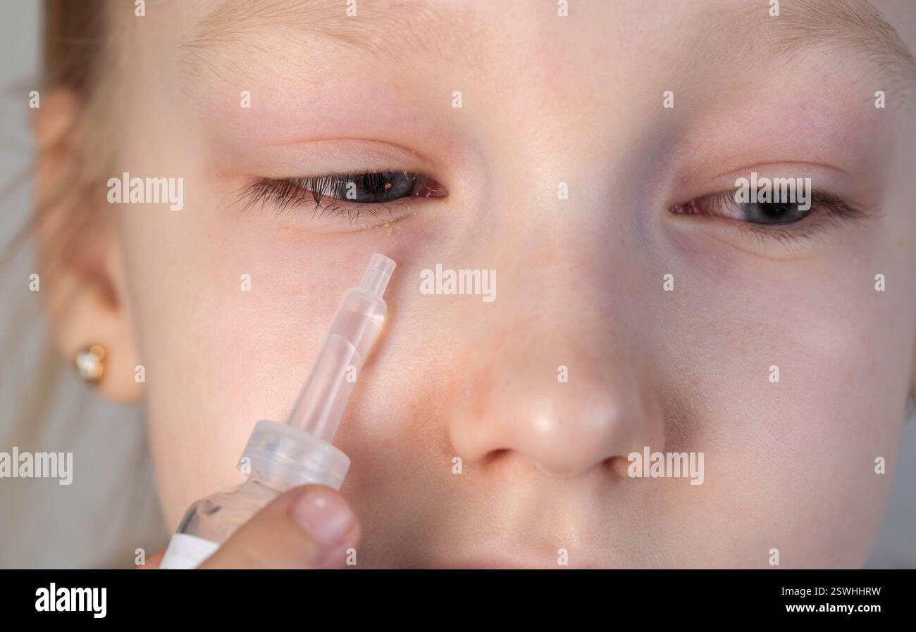 A caucasian girl holds eye drops near her inflamed eyes with pus ...