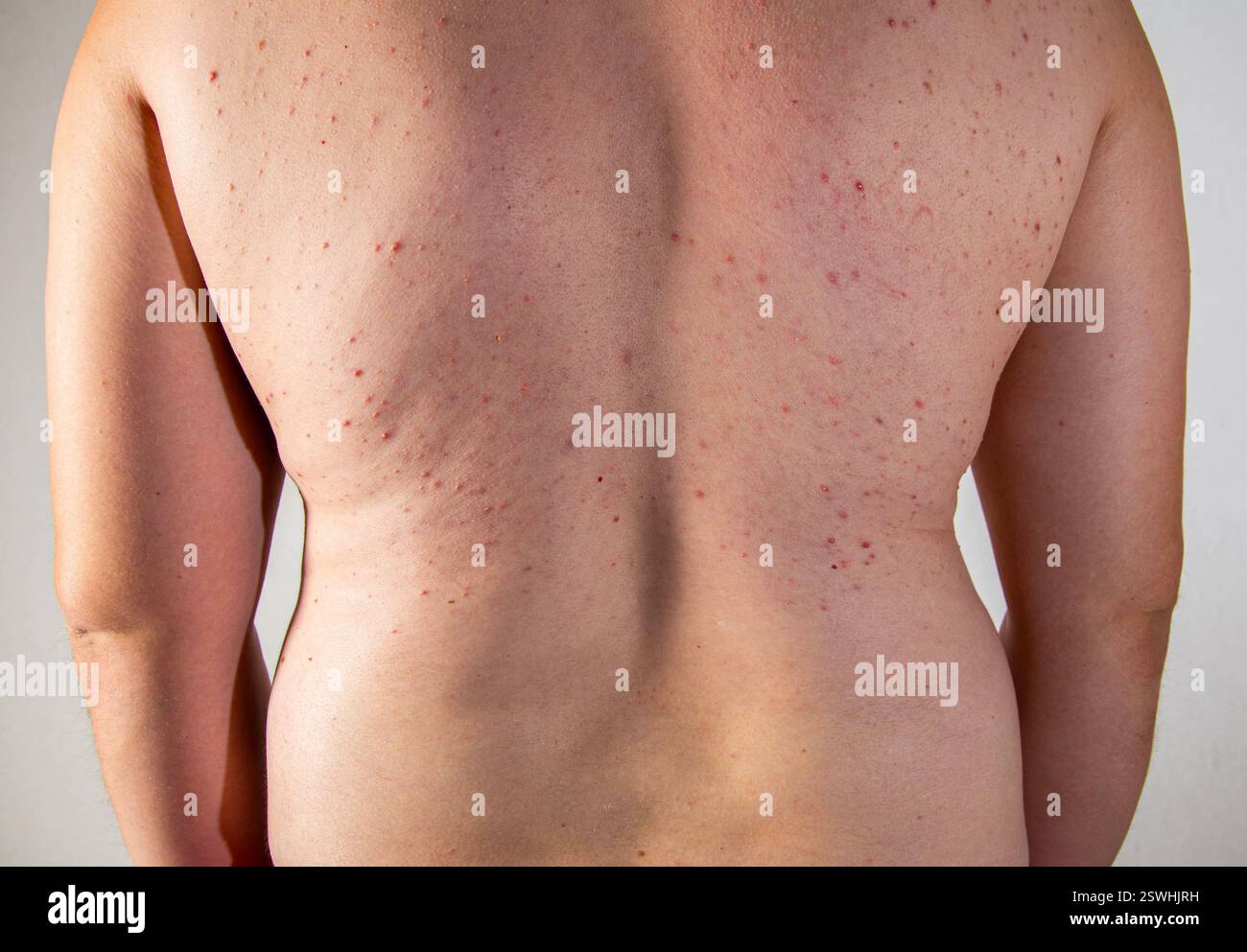 Red pimples on a man's back. Concept of inflammation of the sebaceous ...