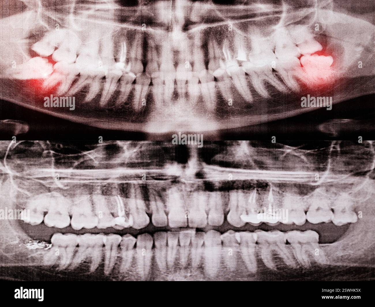 Two panoramic x-rays of lower wisdom teeth and removed wisdom teeth ...