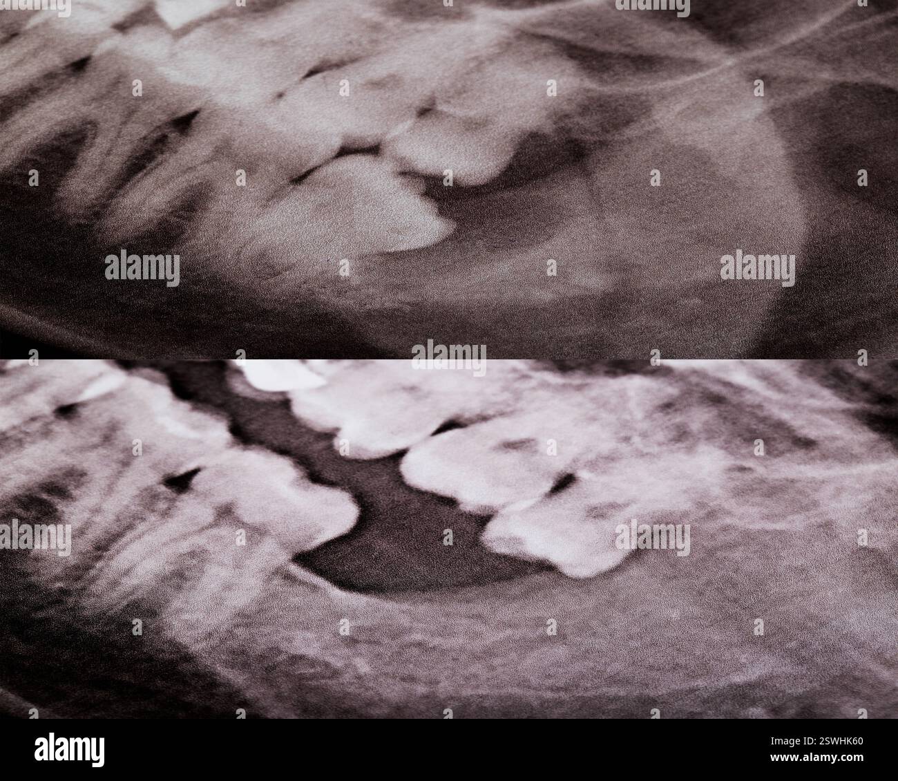 X-ray of the lower wisdom tooth and after wisdom tooth removal Stock ...