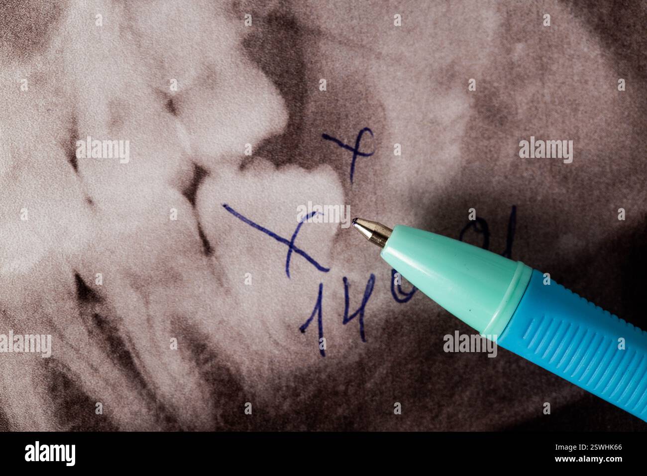 Pen and crossed out wisdom teeth on a dental x-ray, removal of wisdom ...