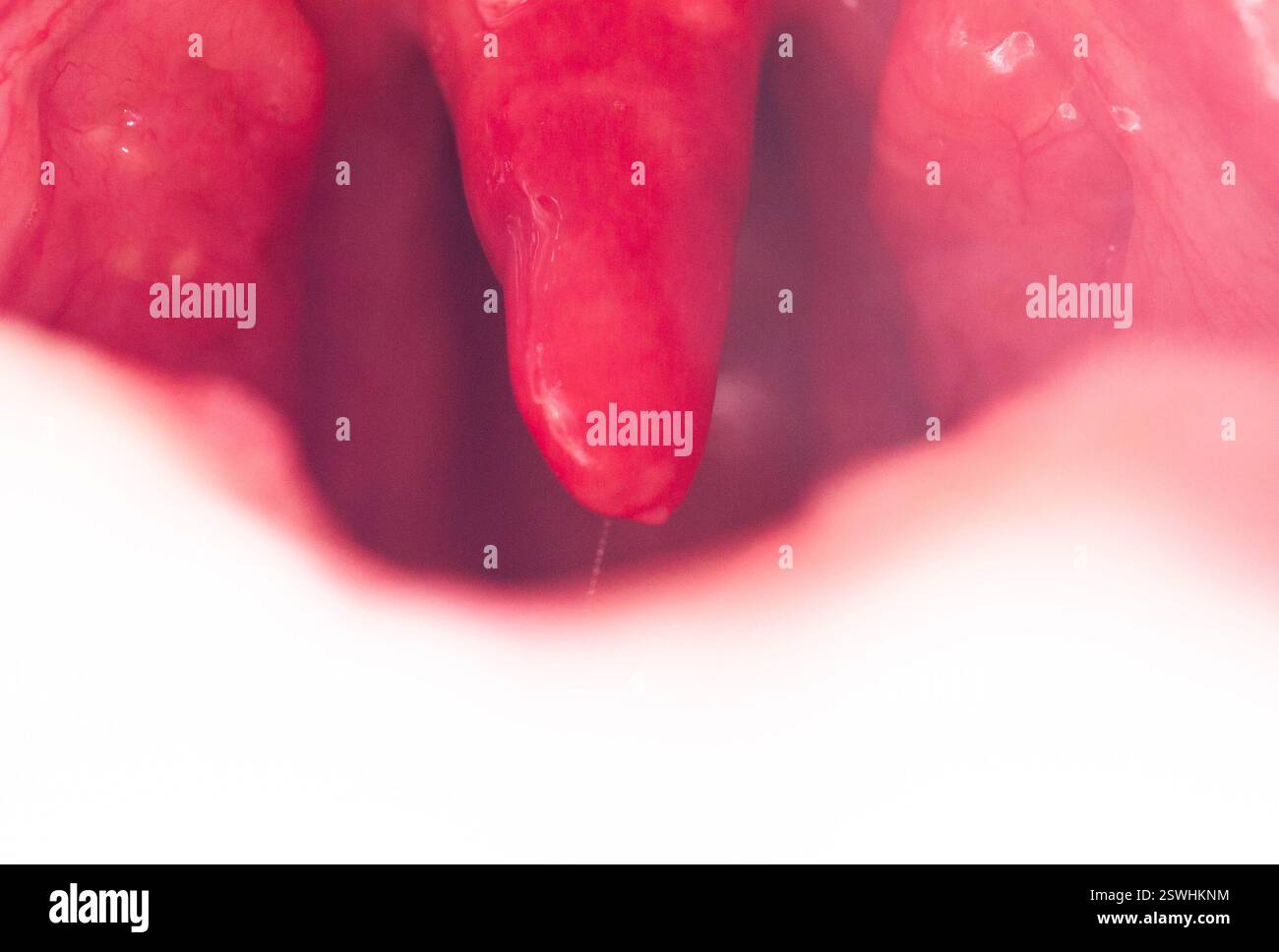 Uvulitis and sore throat in the oral cavity due to illness ...