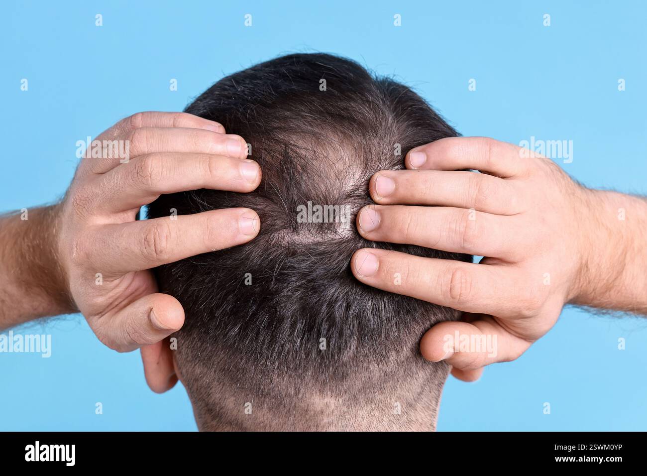 Baldness problem. Man with bald spot on light blue background, back ...