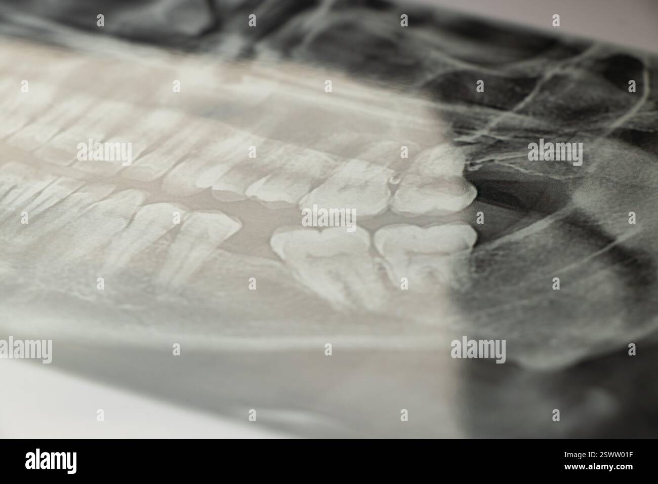 Panoramic dental x-ray for acute pain from wisdom tooth, dentistry and ...