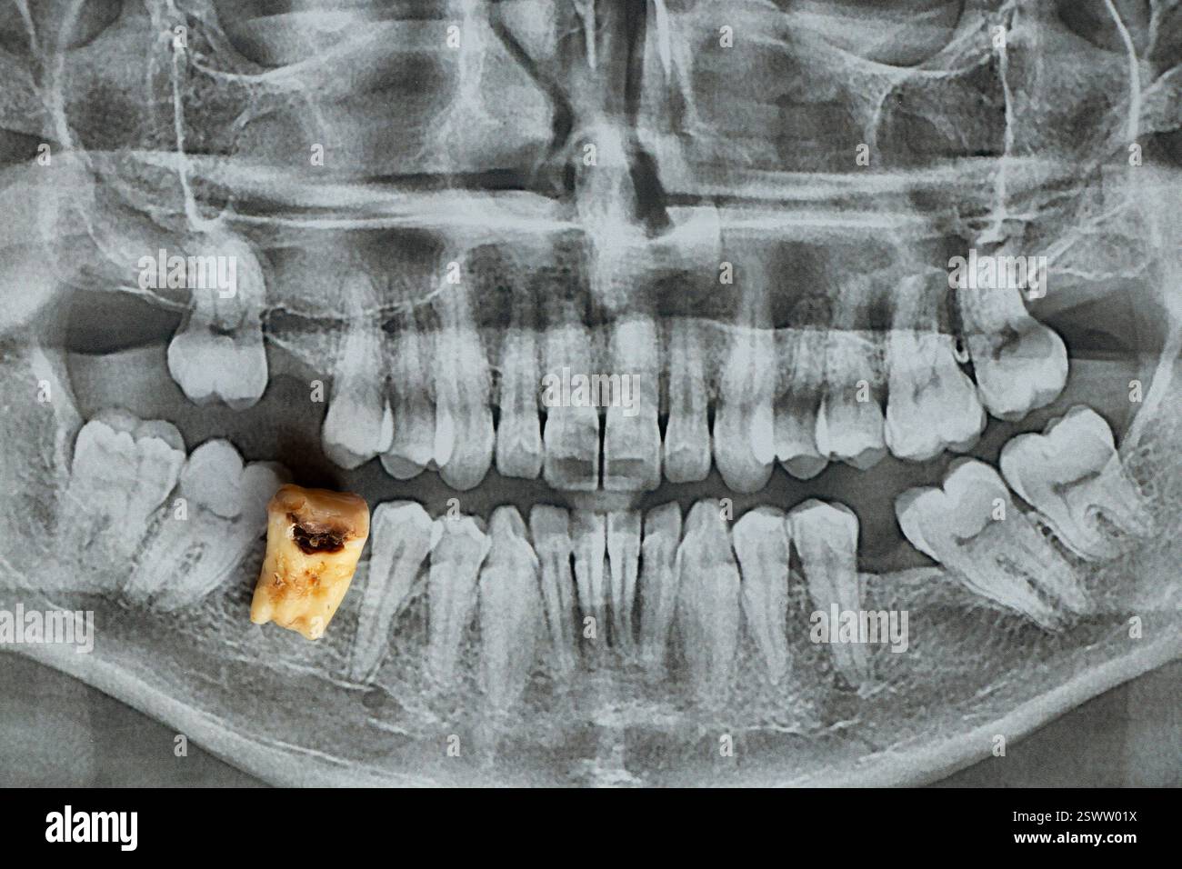 Extracted wisdom tooth with a hole lies on a panoramic image of male ...