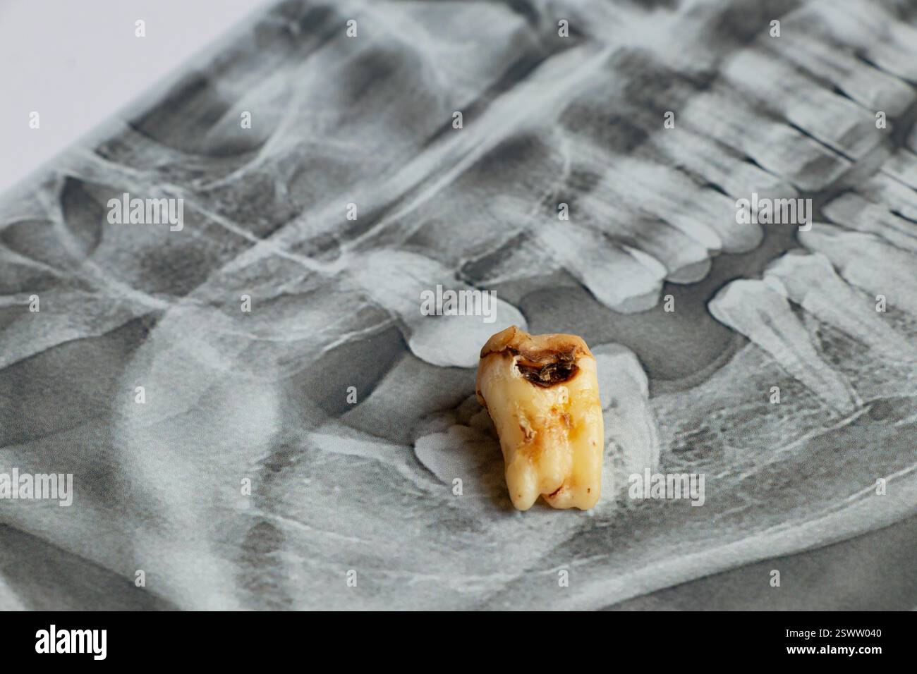 Extracted wisdom tooth with a hole lies on a panoramic image of male ...