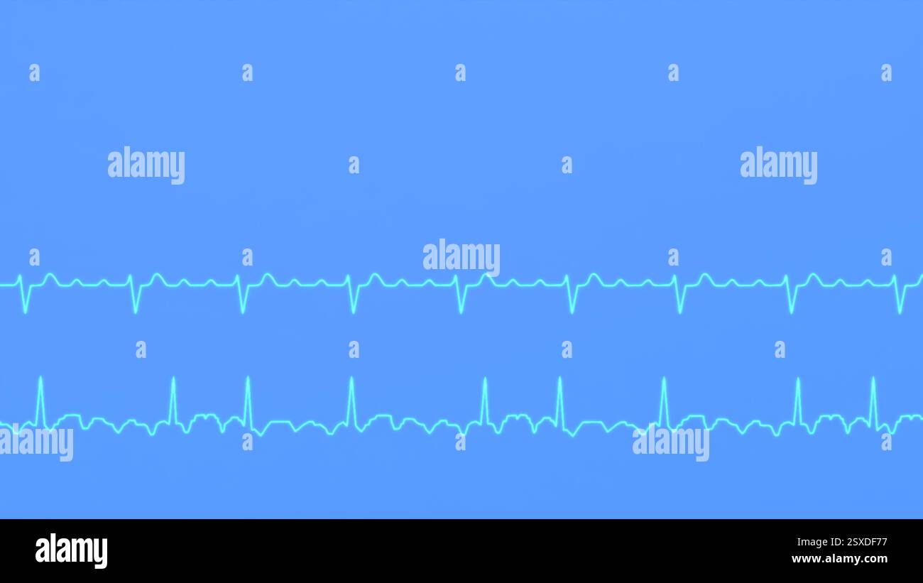 ECG graphs of regular and irregular atrial flutter Stock Photo - Alamy