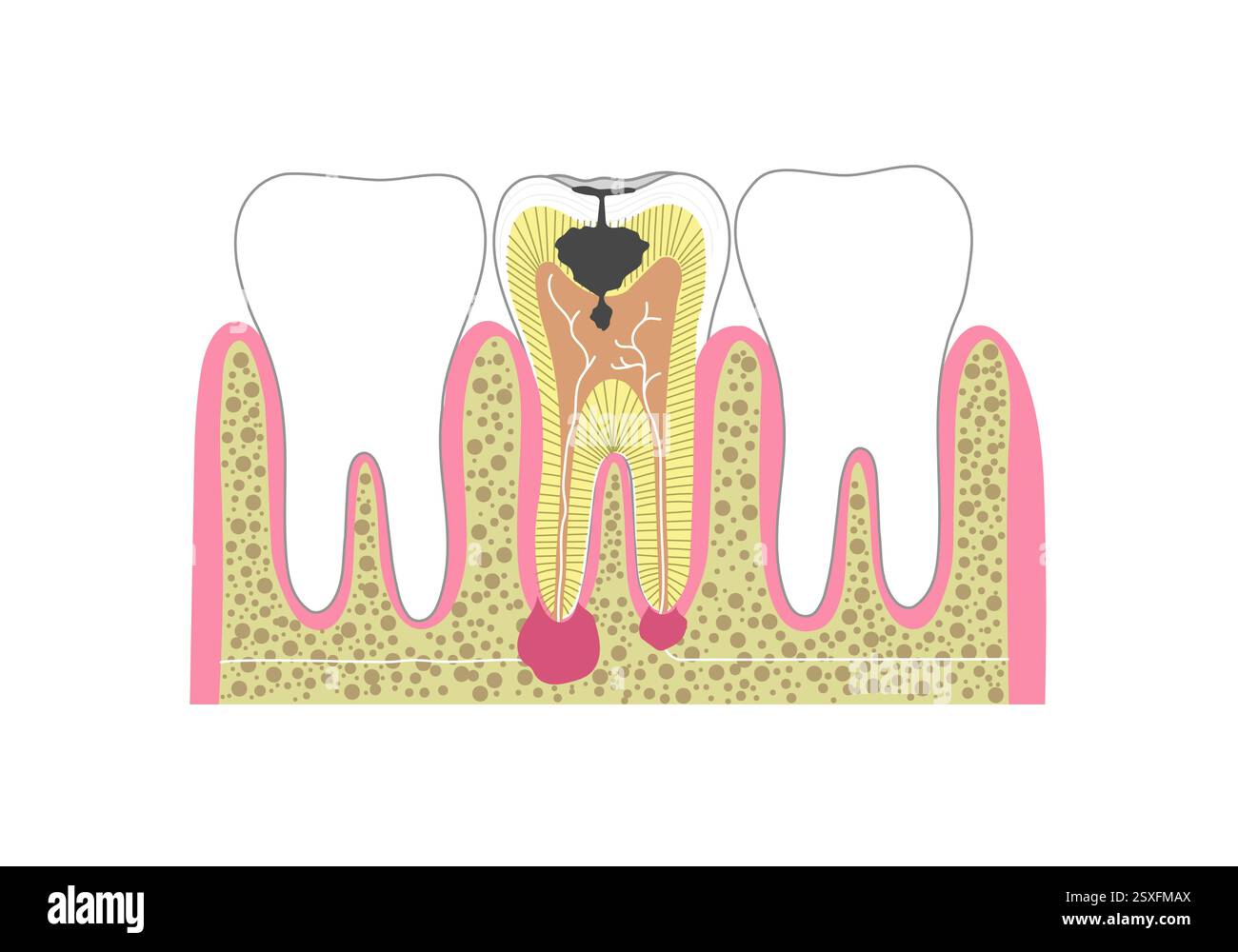 Caries and periodontitis illustration on cross section of tooth Stock ...