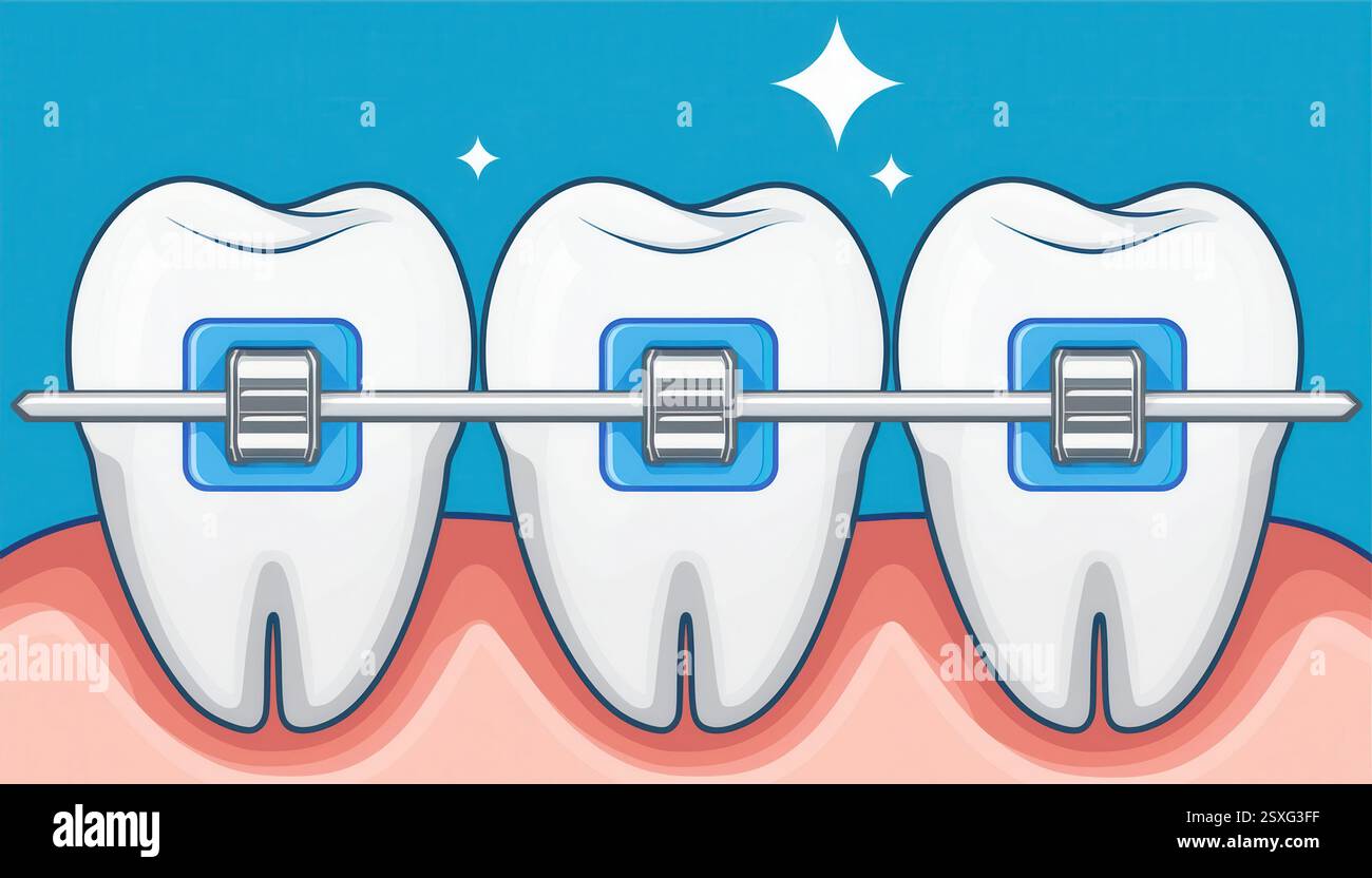 This colorful illustration depicts properly aligned teeth with braces ...