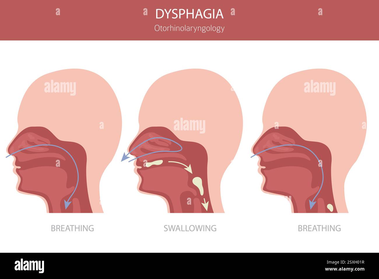 Oral dysphagia diseases. Otorhinolaryngology. Difficult swallowing ...