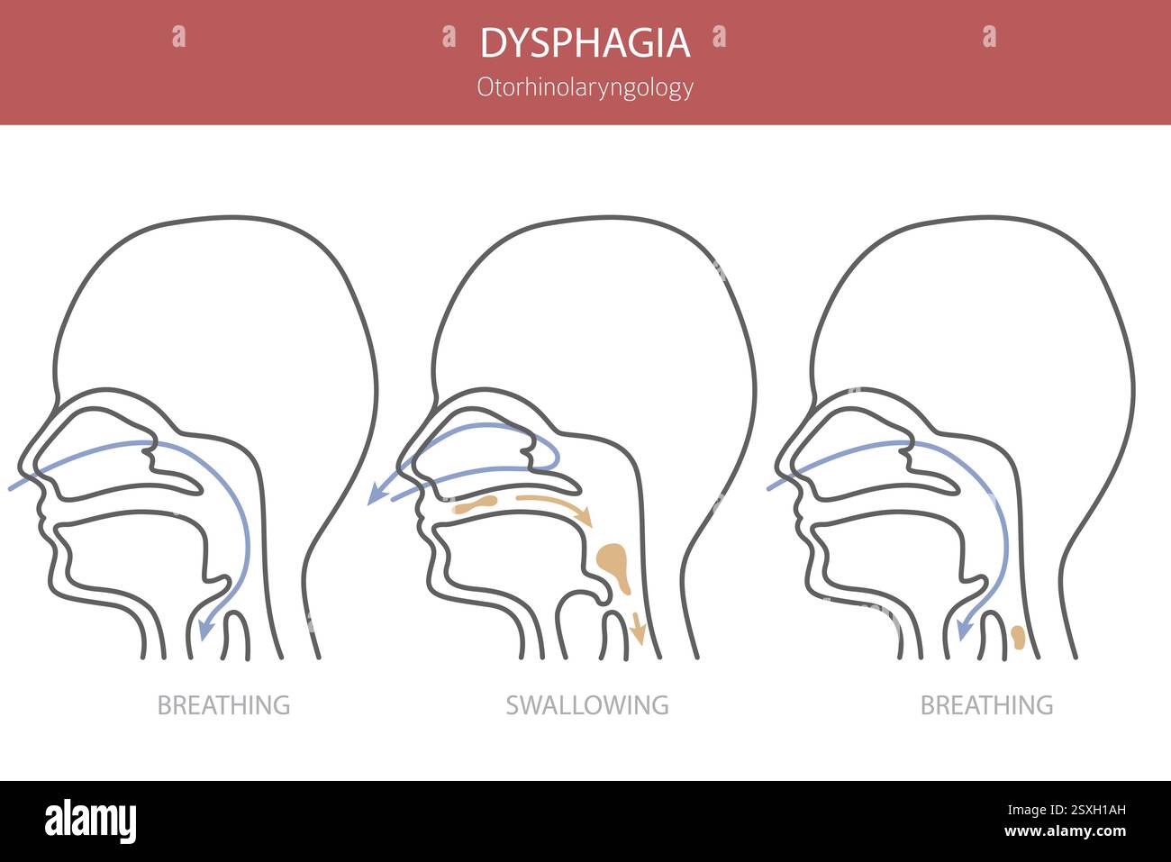 Oral dysphagia diseases. Otorhinolaryngology. Difficult swallowing ...
