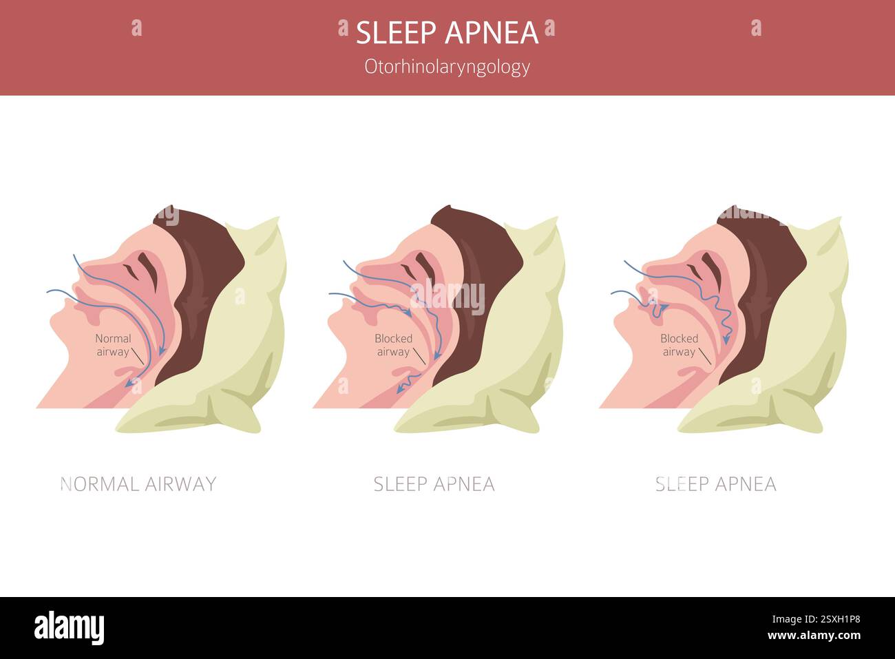 Sleep Apnea diseases. Otorhinolaryngology. Sleep related breathing ...