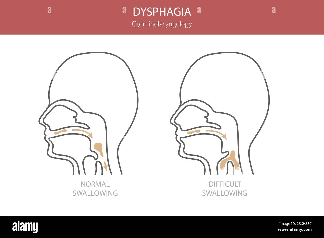 Oral dysphagia diseases. Otorhinolaryngology. Difficult swallowing ...