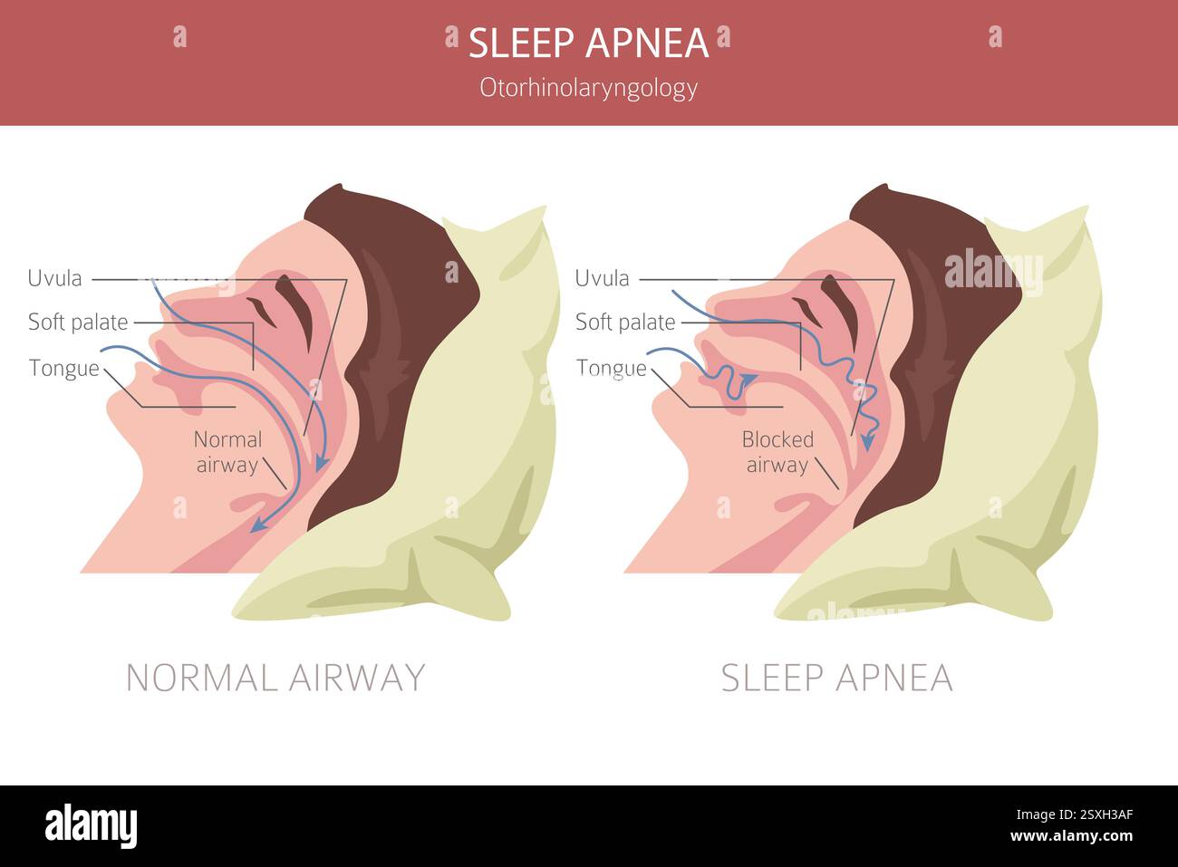 Sleep Apnea diseases. Otorhinolaryngology. Sleep related breathing ...