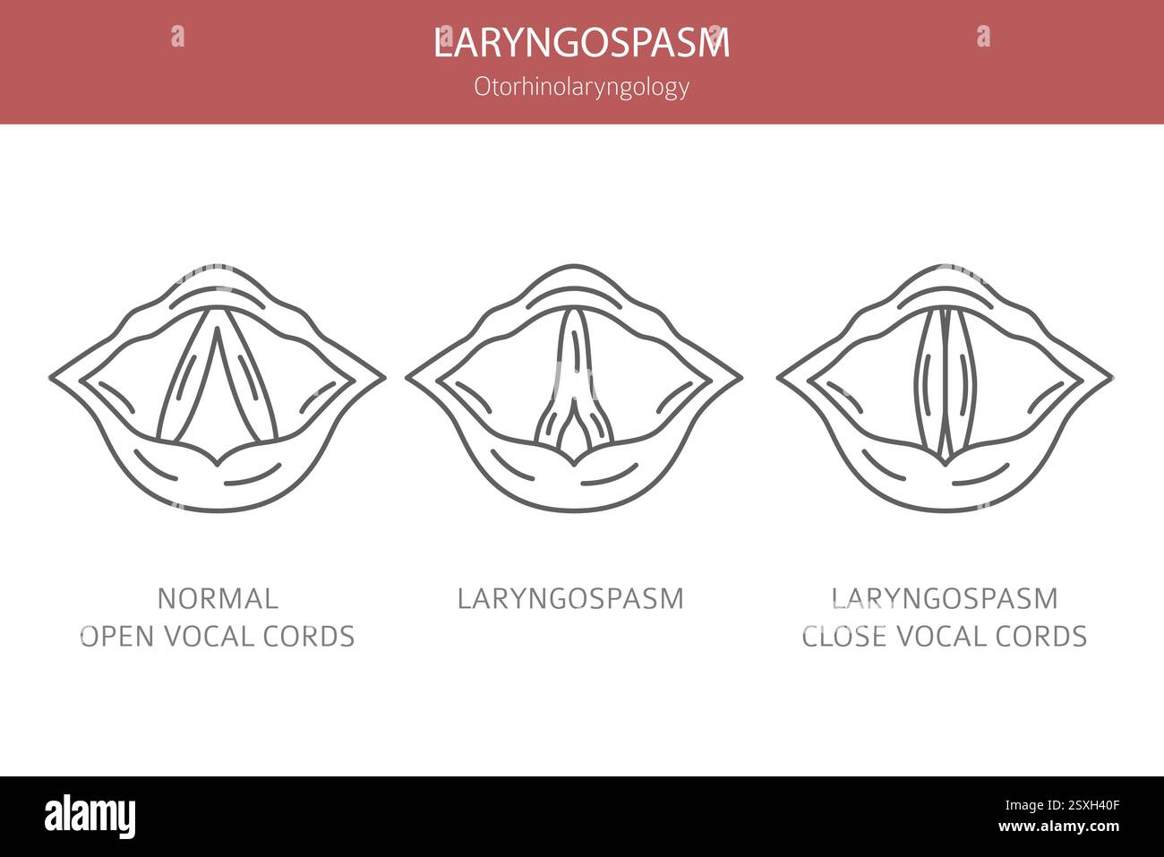 Laryngospasm diseases. Otorhinolaryngology. Vocal cord disfunction ...