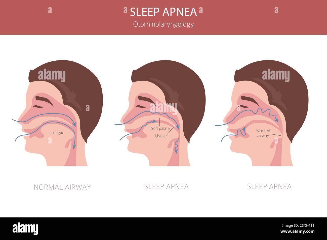 Sleep Apnea diseases. Otorhinolaryngology. Sleep related breathing ...