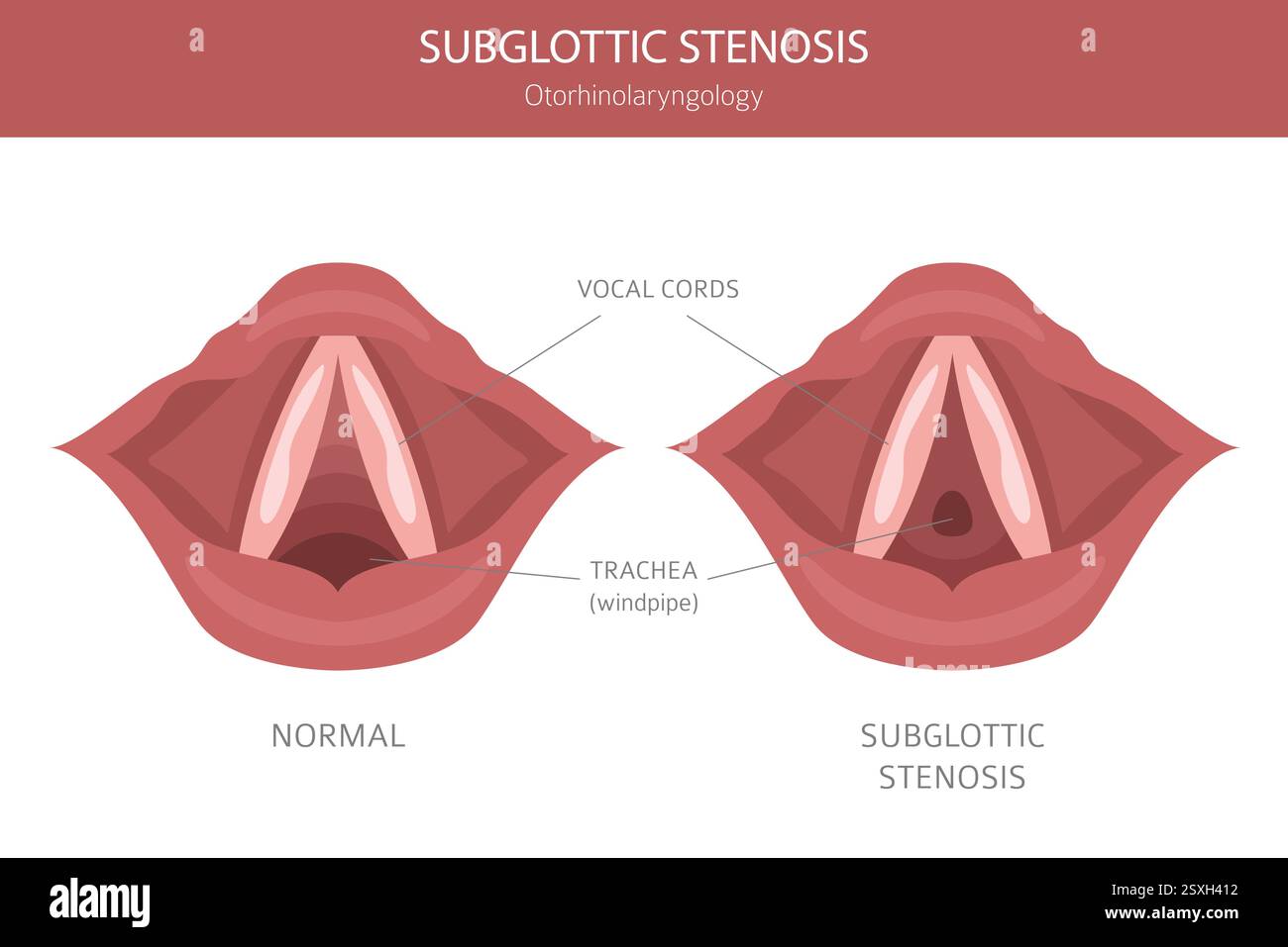 Subglottic Stenosis diseases. Pulmonology, otolaryngology. Medical infographic design. Vector ...