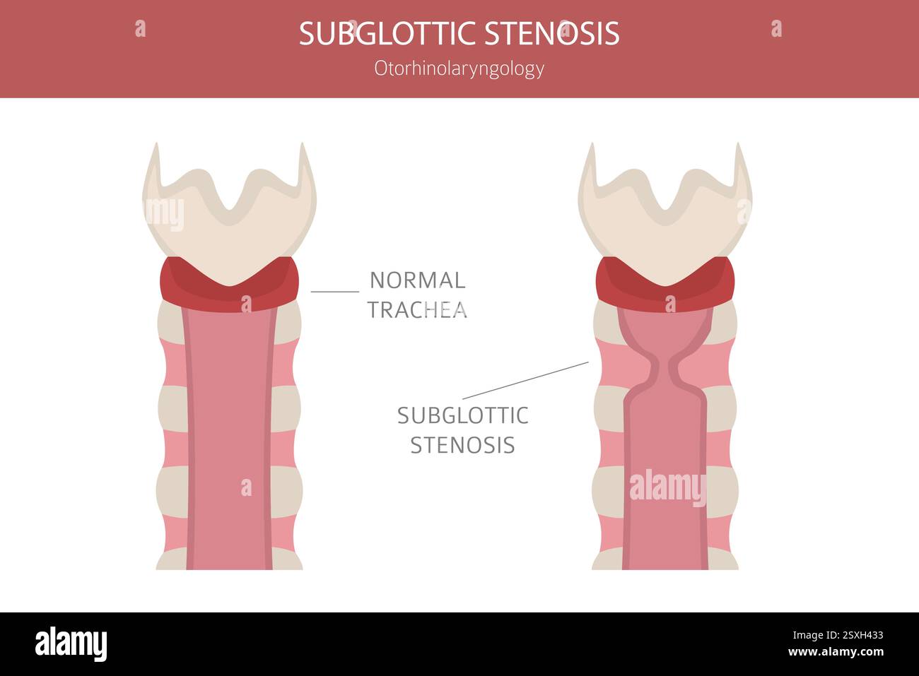 Subglottic Stenosis diseases. Pulmonology, otolaryngology. Medical ...