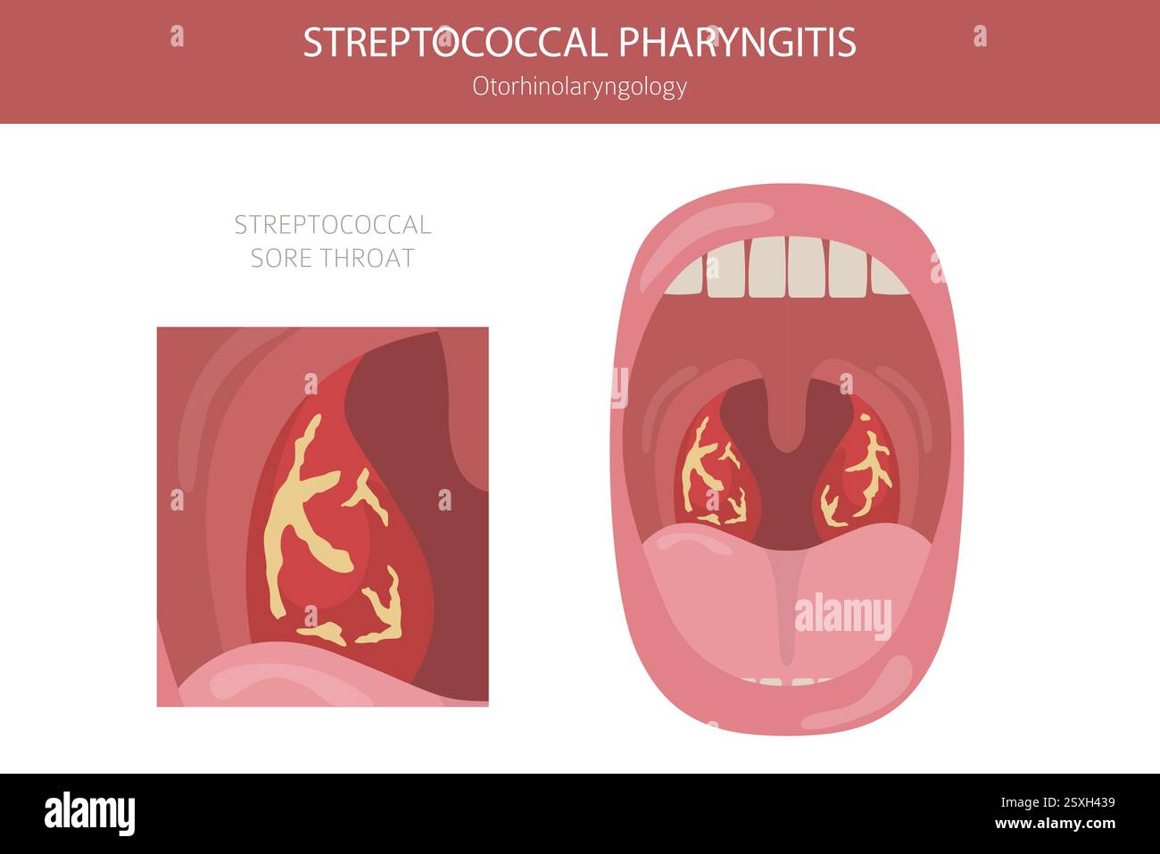 Tonsils and throat diseases. Streptococcal Pharyngitis. Medical ...