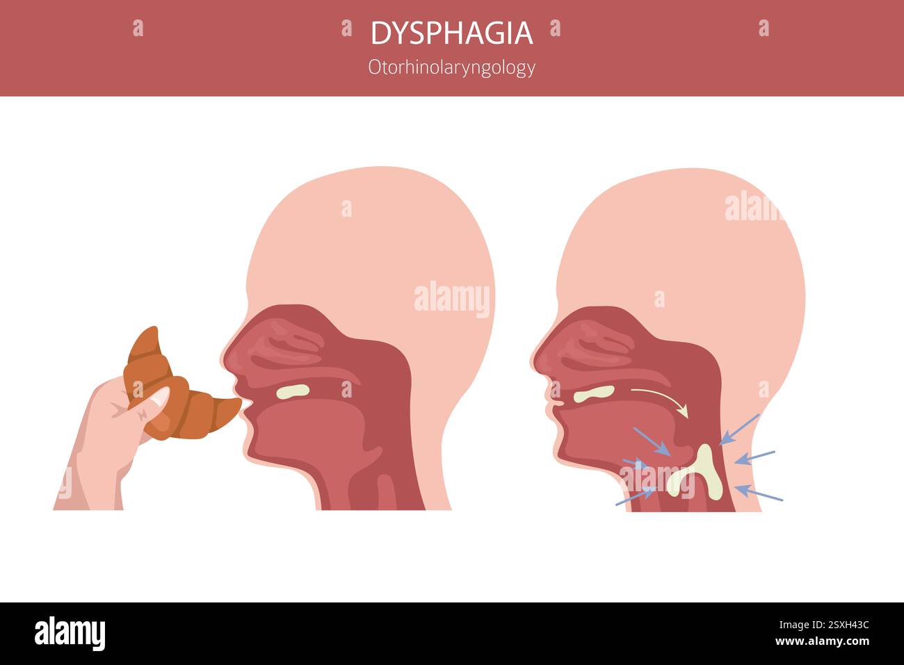 Oral dysphagia diseases. Otorhinolaryngology. Difficult swallowing. Medical infographic design ...