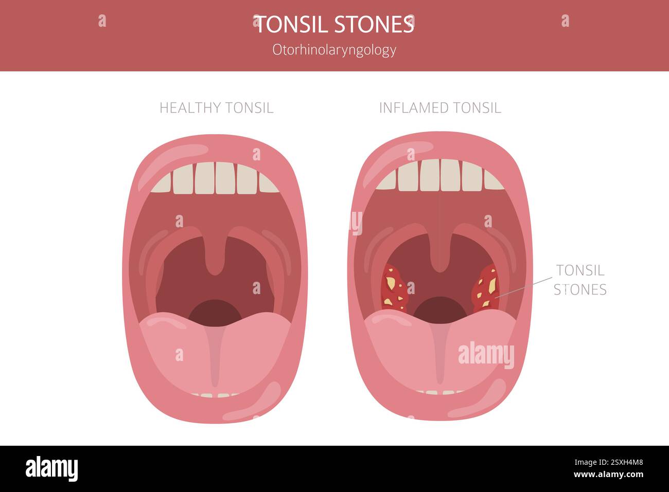 Tonsil stones diseases. Otorhinolaryngology. chronic caseous tonsillitis. Medical infographic ...