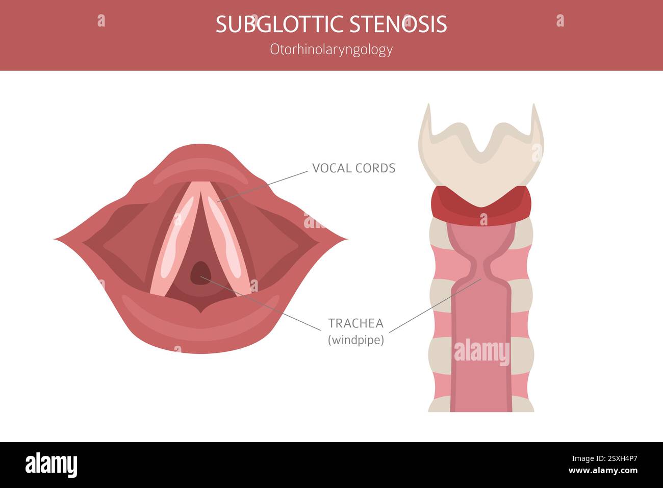 Subglottic Stenosis diseases. Pulmonology, otolaryngology. Medical infographic design. Vector ...