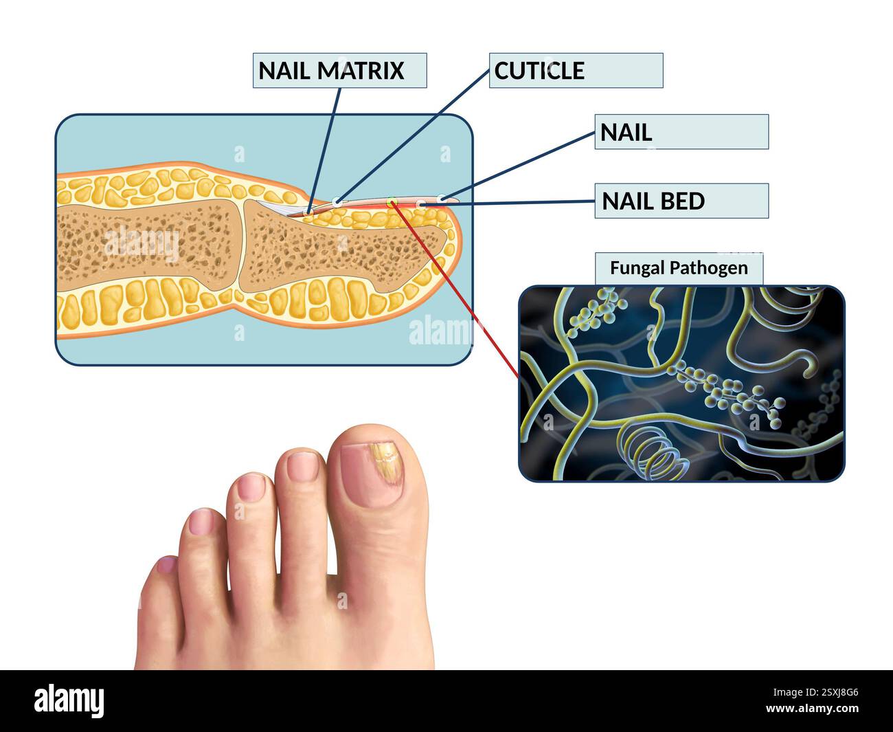 Diagram showing fungal pathogens in a toenail. Digital illustration ...