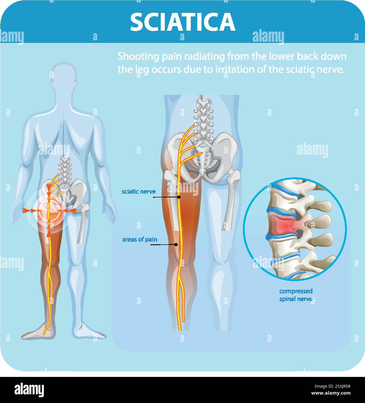 Region affected Stock Vector Images - Alamy
