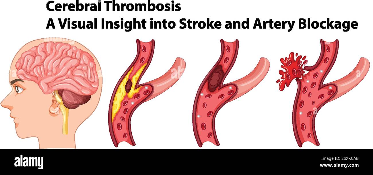 Illustration of brain, arteries, and blockage process Stock Vector ...