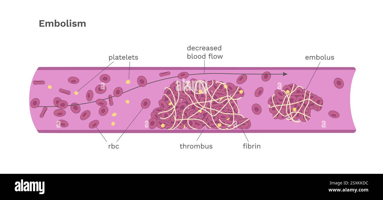 Embolism medical chart with captions. Blood clot movement in the blood ...