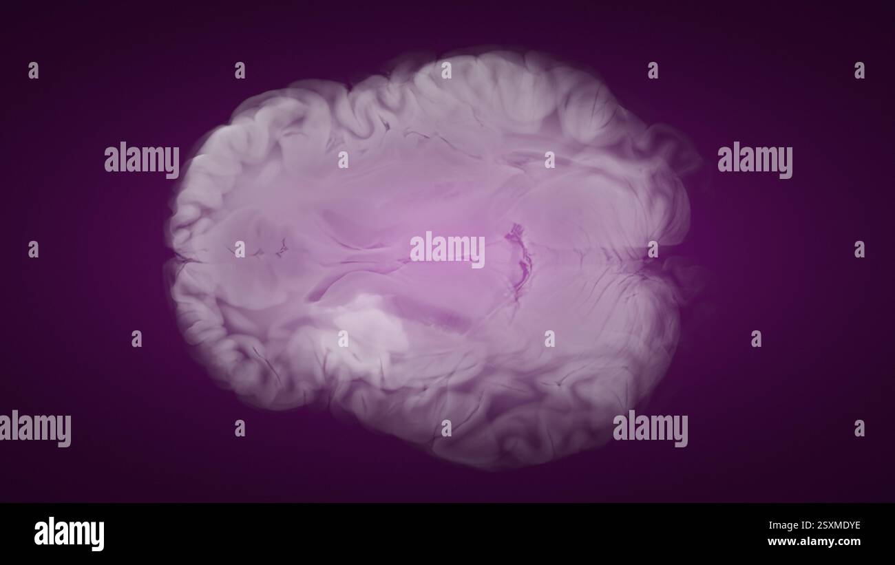 Brain MRI scan depicting a chronic ischemic stroke, with a lighter area ...