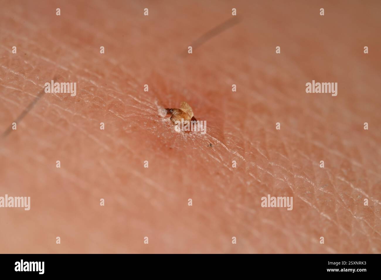 close-up of a scab on skin Stock Photo - Alamy
